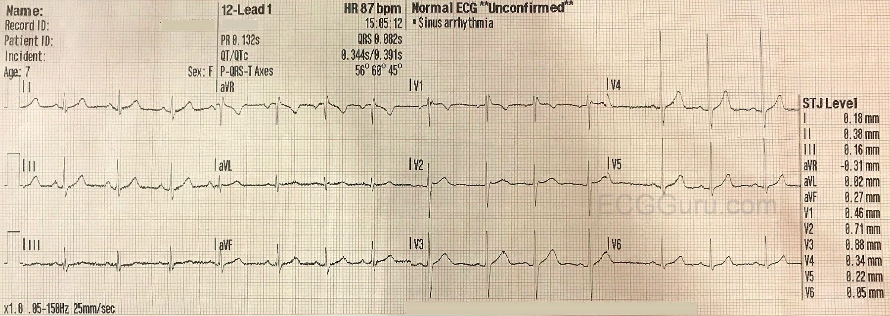 Instructors Collection Ecg Normal Ecg In Seven Year Old Girl Ecg Guru Instructor Resources